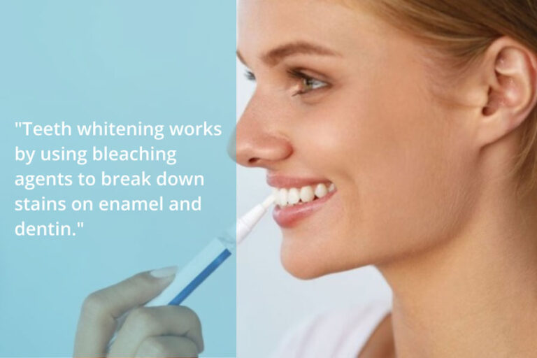 The Science Behind Teeth Whitening: How It Works and Your Options